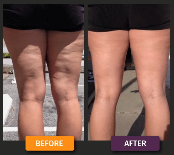 CELLULITE PRO 1+1 – Naturesfinest